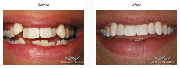Orthodontics - Blue Court Dental Centre, Harrow