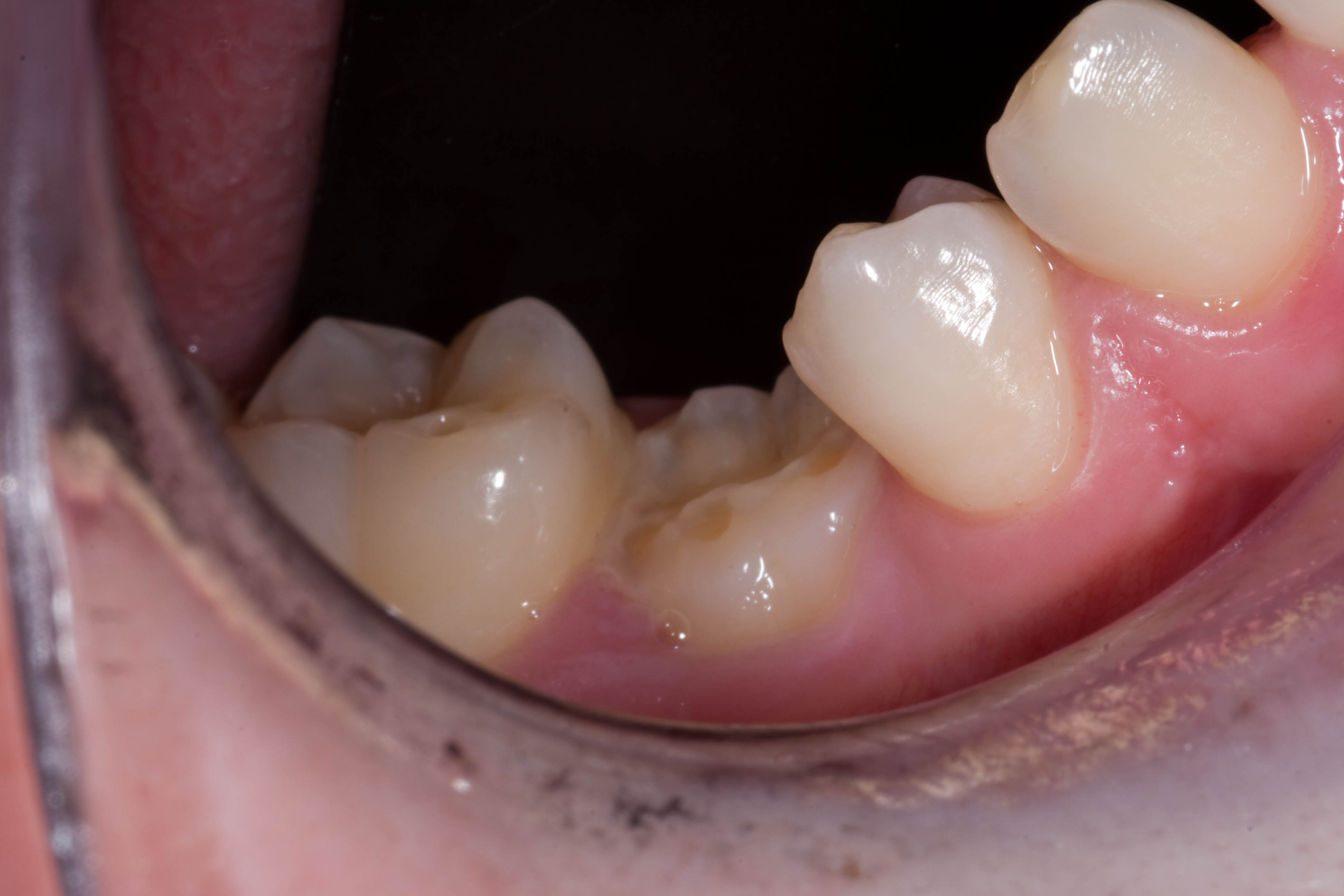 Orthodontics Retained Baby Teeth at Loren Bona blog