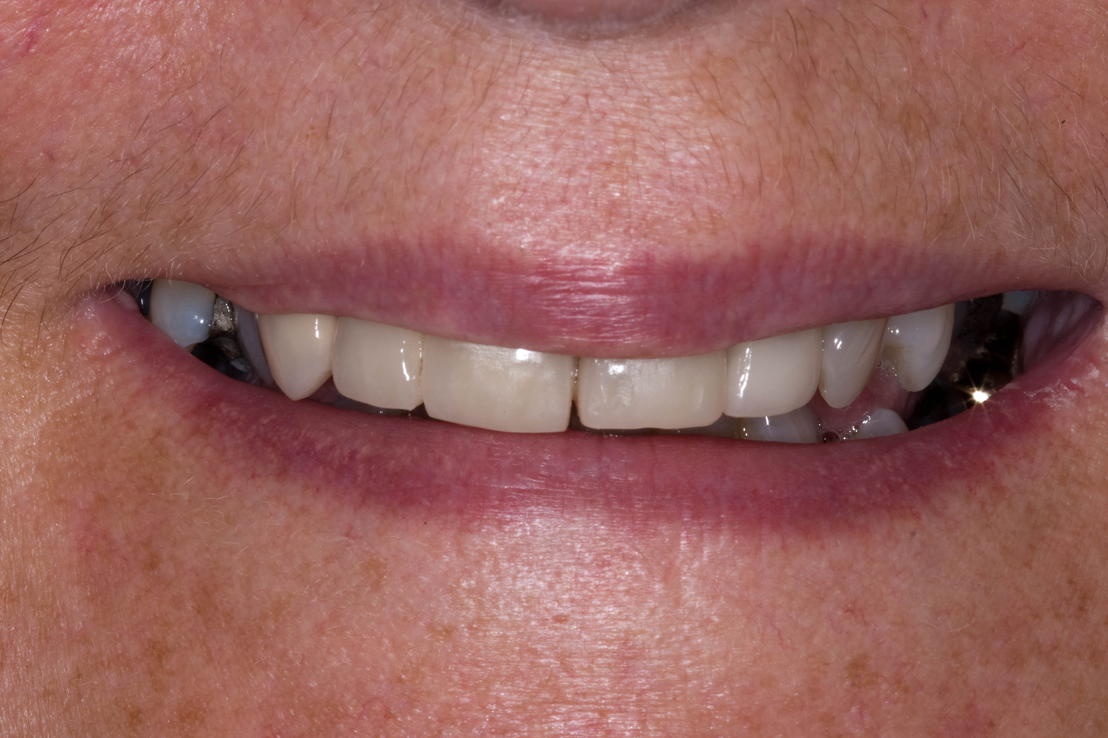 My Bridge is loose - Blue Court Dental Centre, Harrow