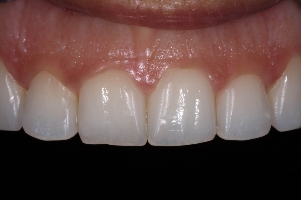 "My front tooth is hitting my bottom lip" | Blue Court Dental Centre ...