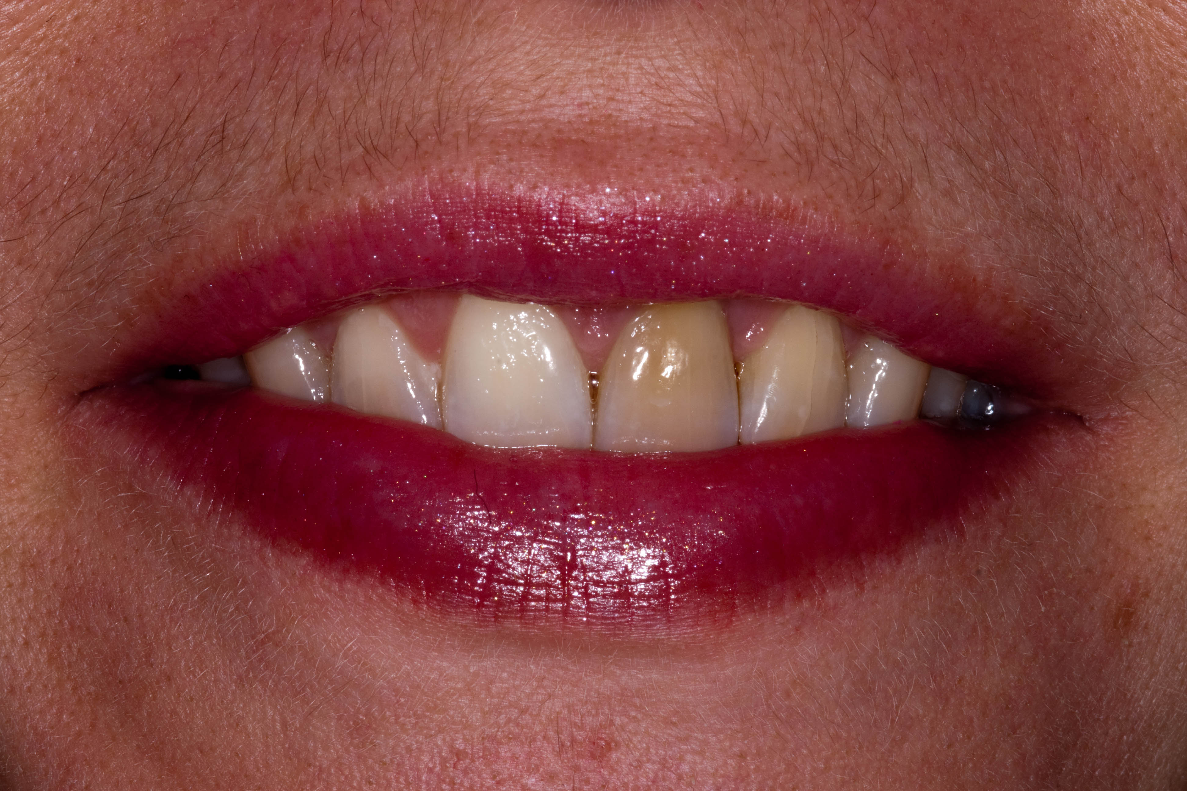 I WANT TO IMPROVE THE COLOUR OF MY FRONT TOOTH | Blue Court Dental ...