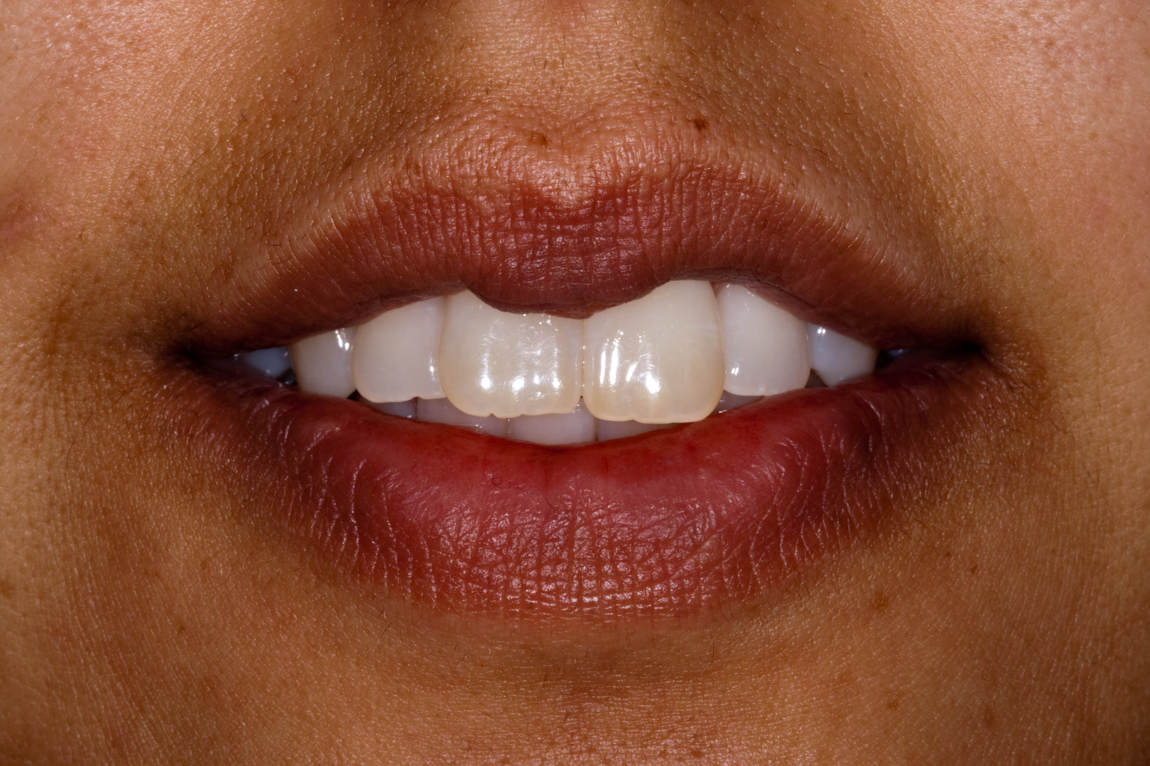 Can my crooked front teeth be straightened ? | Blue Court Dental Centre ...