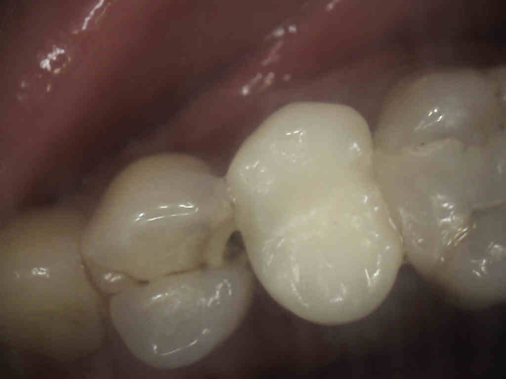 There's a hole in my tooth! | Blue Court Dental Centre, Harrow