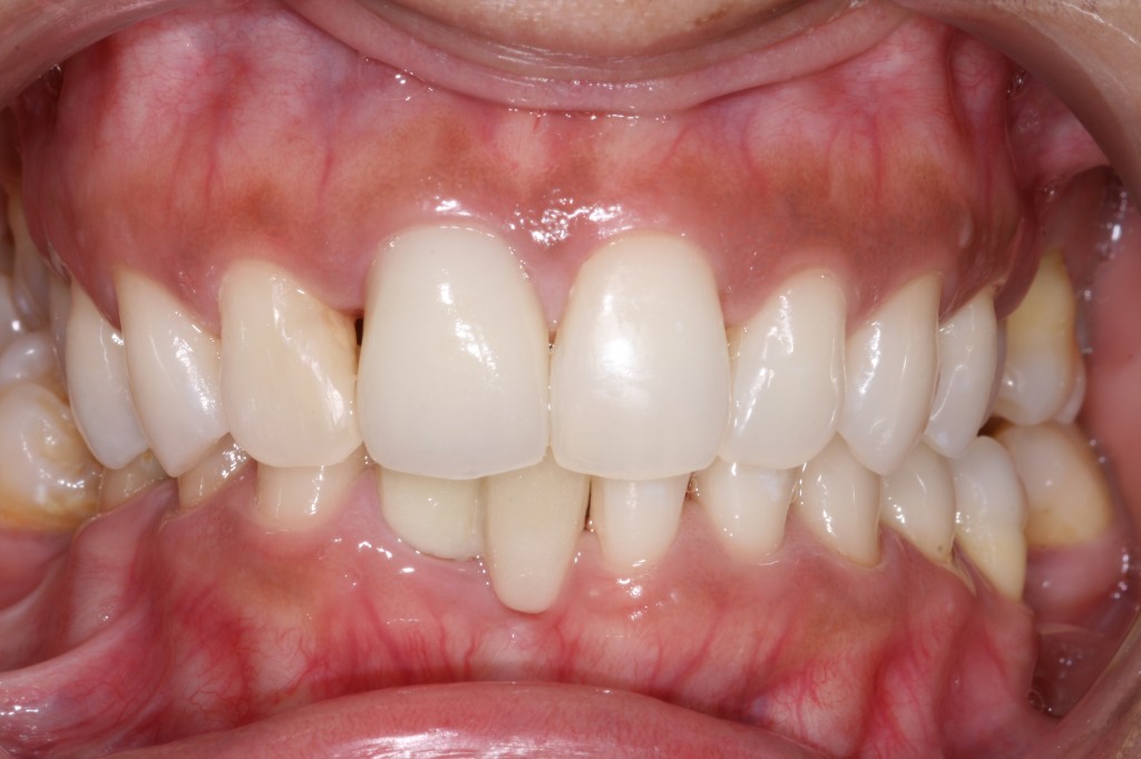 Discoloured Teeth and Crown - Blue Court Dental Centre, Harrow